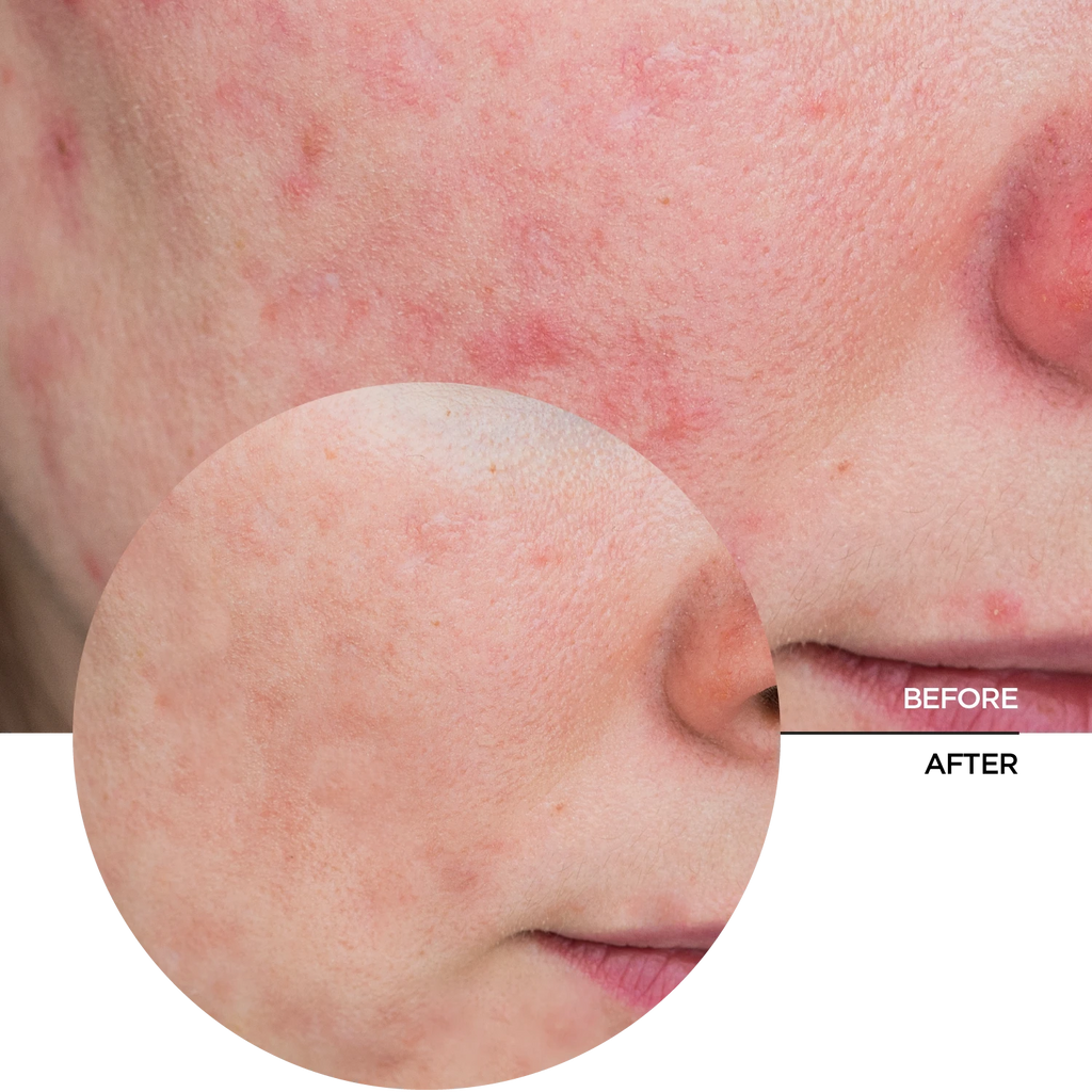 Azelaic Acid 10% – Revox B77